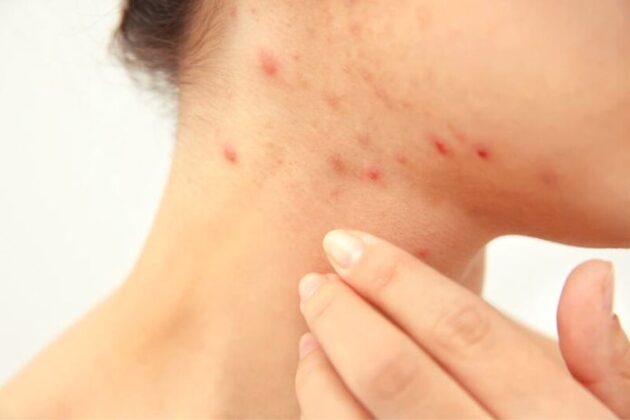 Pimple On The Neck: 7 Tips To Get Rid Of It